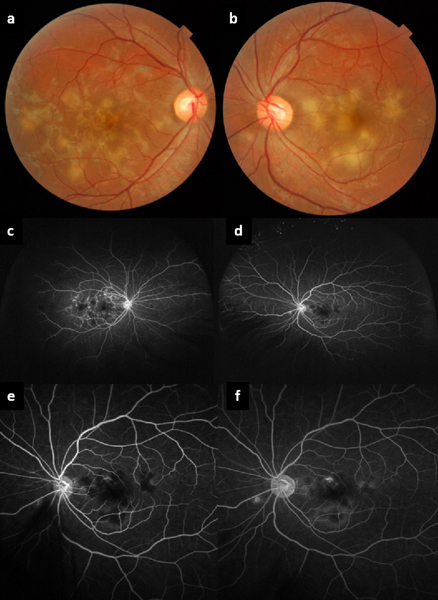 Articulo_Oftalmologia_18580