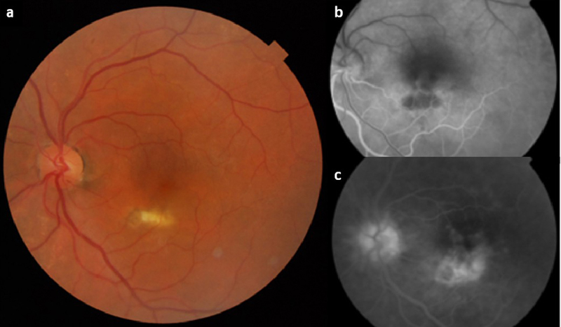 Articulo_Oftalmologia_18580