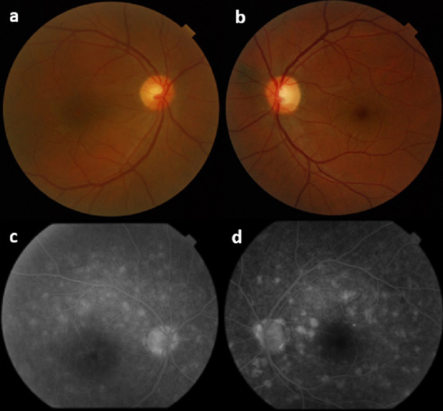 Articulo_Oftalmologia_18580